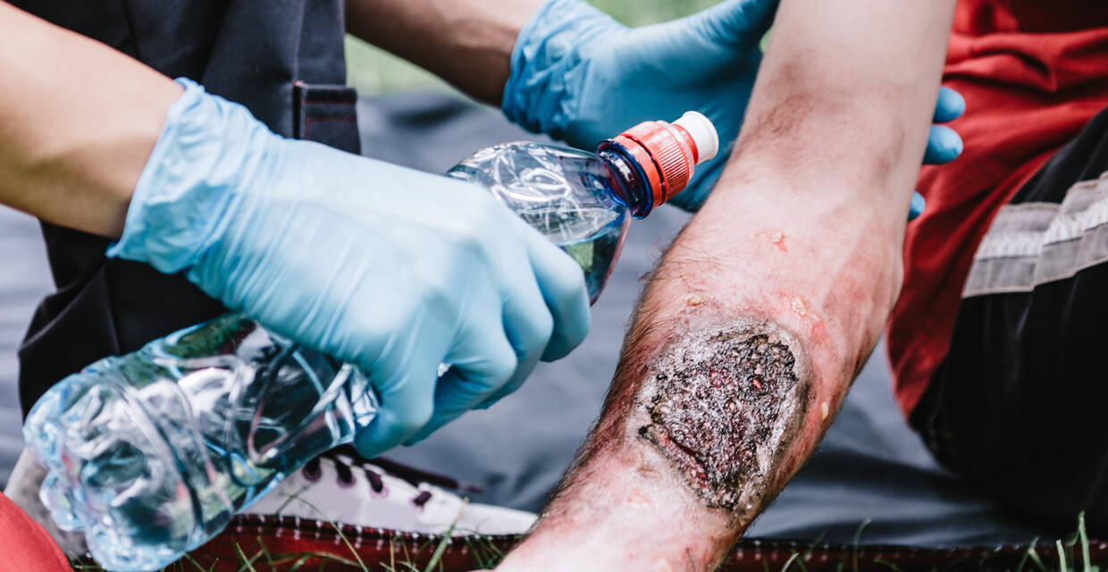 fourth degree burn examples